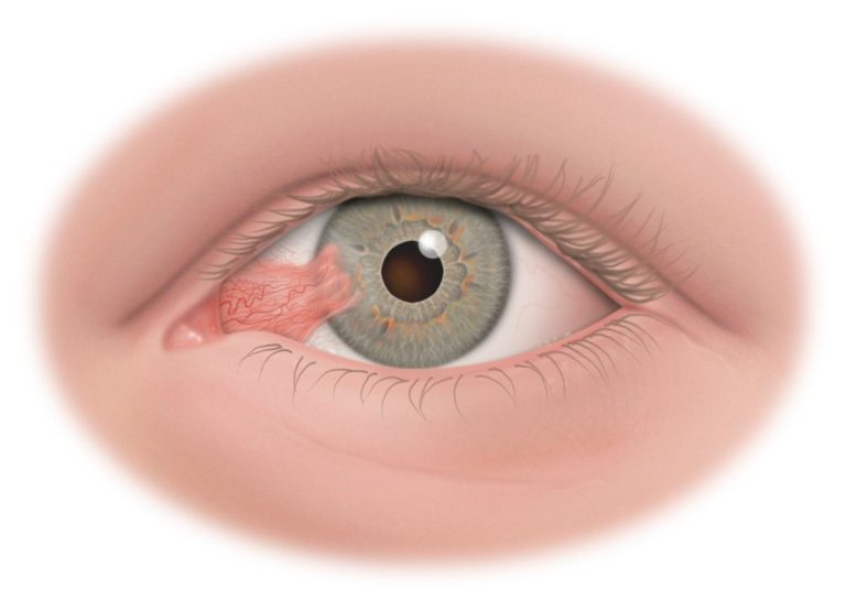 Pterygium causes, treatments and surgery - Clinica Sancho