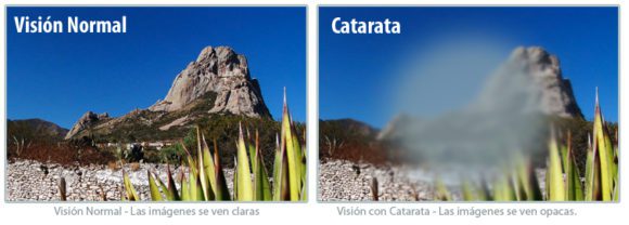 Catarata – Clinica Sancho